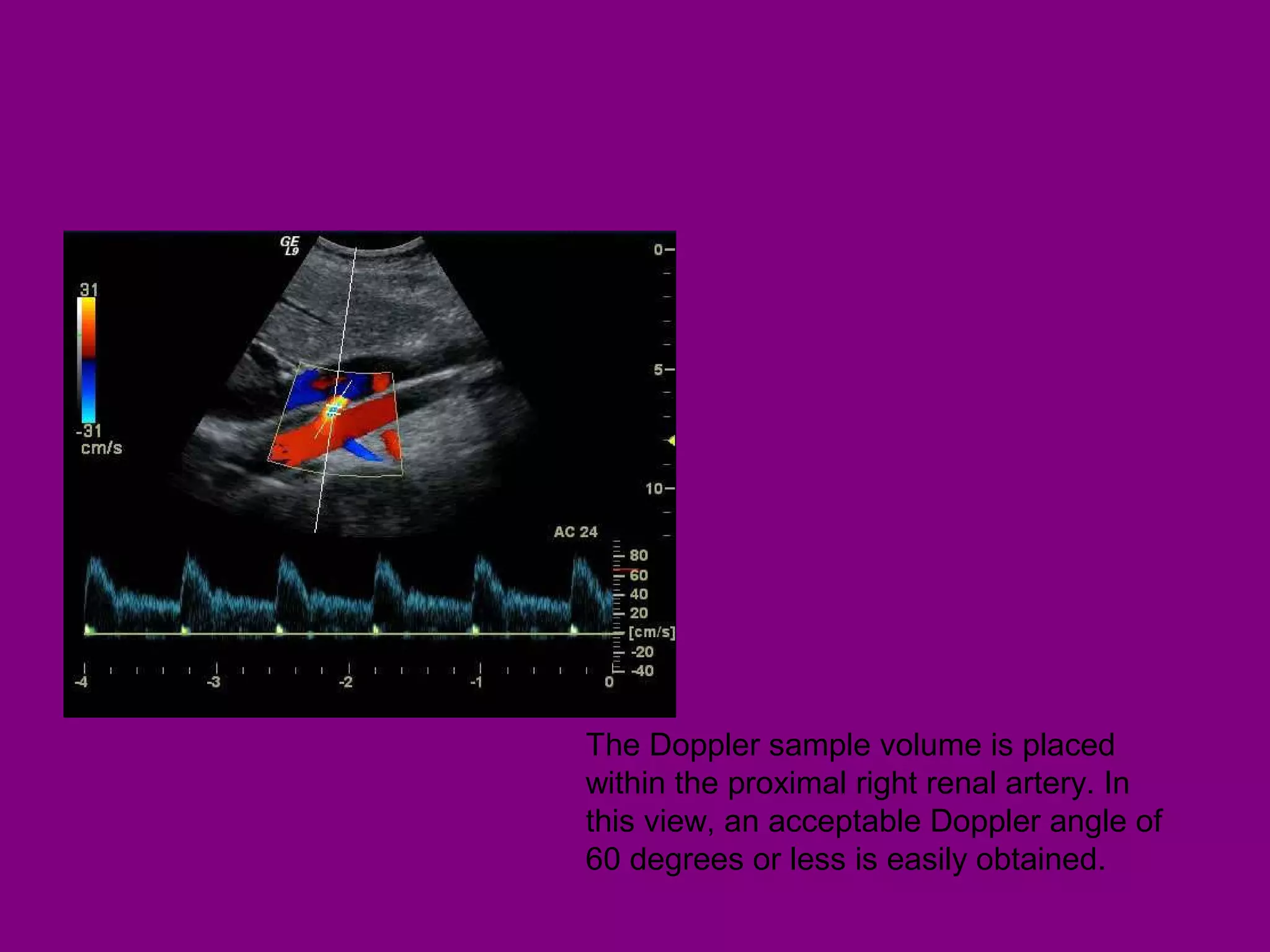 Doppler ultrasound in renal patients | PPT
