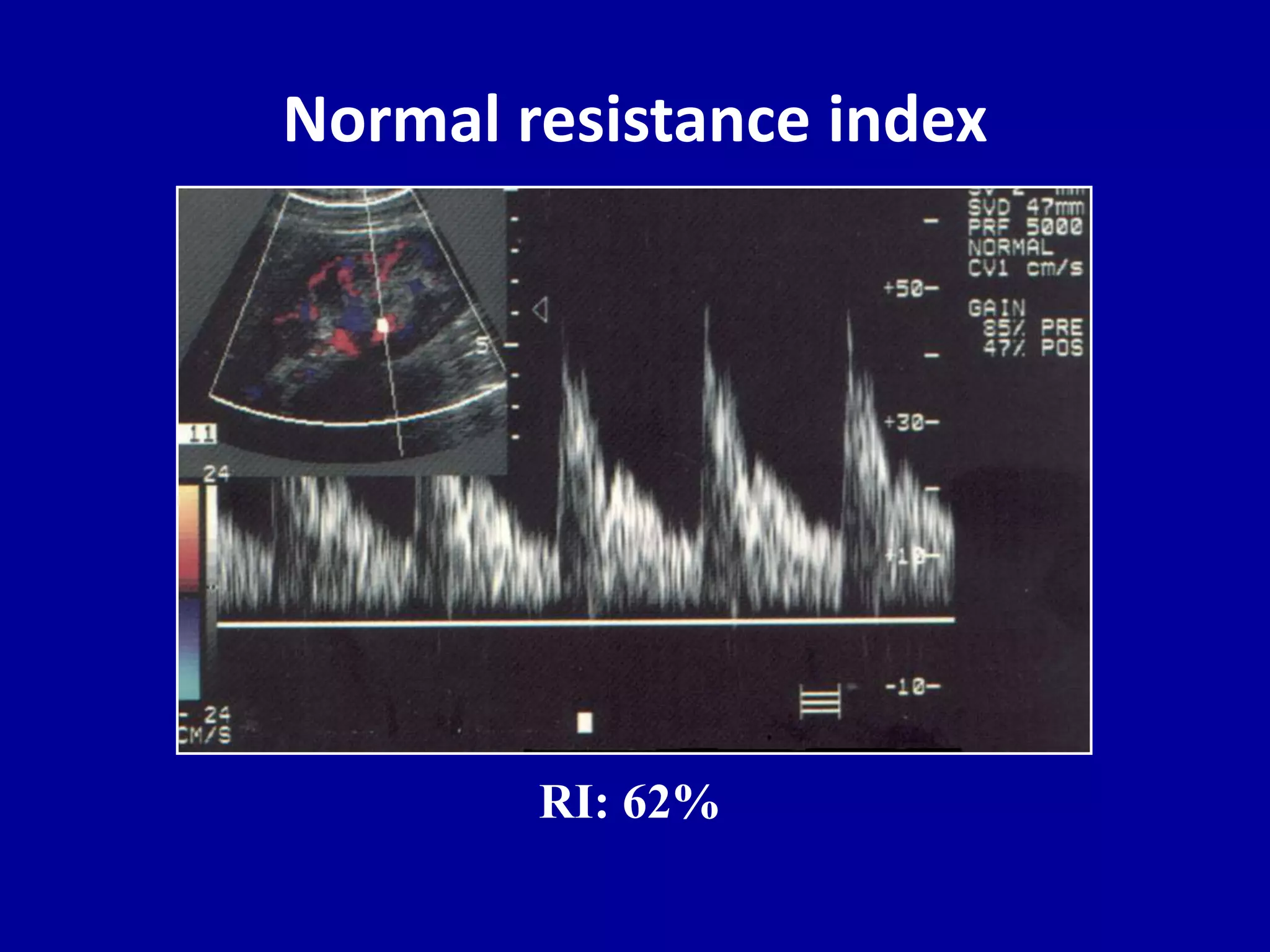 Doppler ultrasound in transplant renal artery stenosis | PPTX