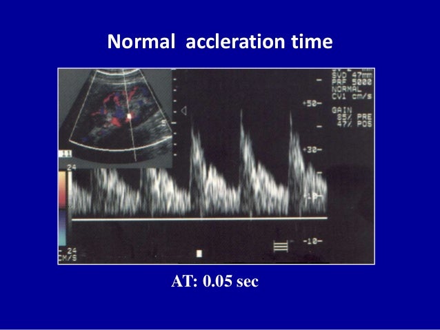 Doppler ultrasound in transplant renal artery stenosis