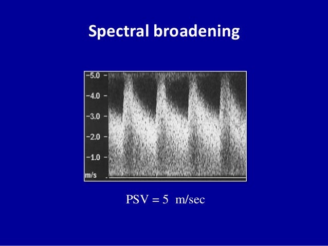 Doppler ultrasound in transplant renal artery stenosis