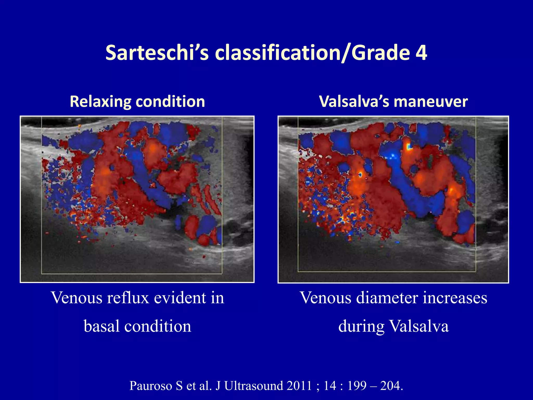 Doppler ultrasound of acute scrotum | PPTX