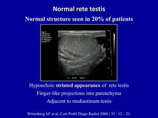 Mediastinum Testis Ultrasound