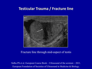 Testicular Rupture Ultrasound