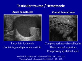 Hematocele Ultrasound