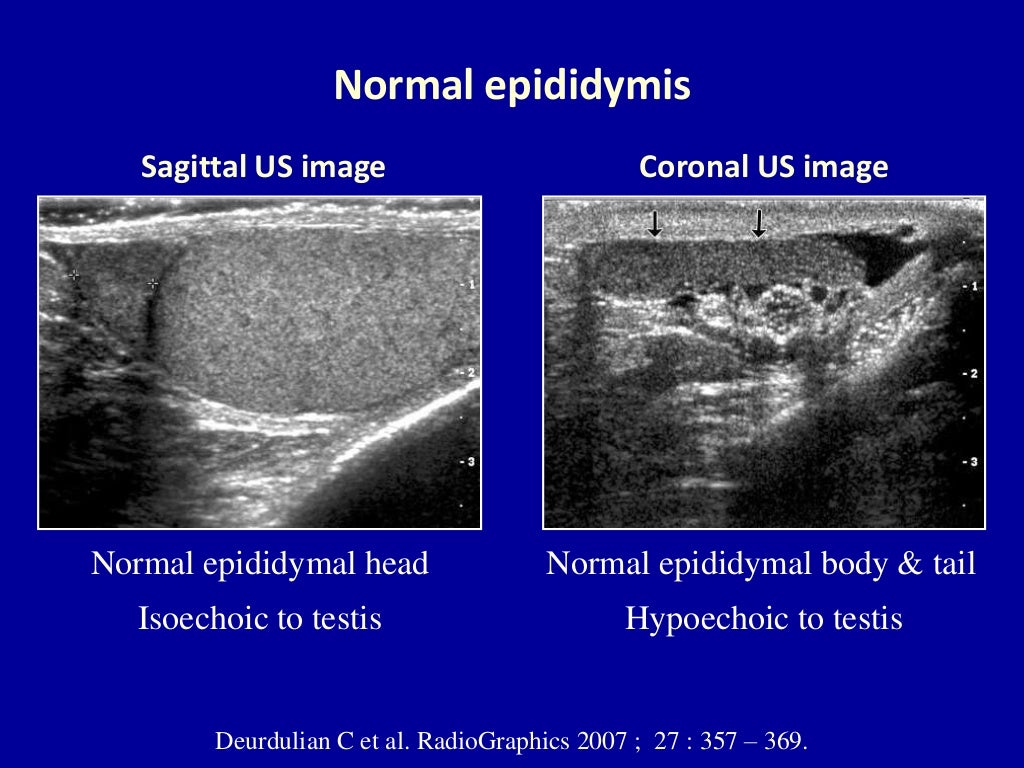 Doppler Ultrasound Of Acute Scrotum 