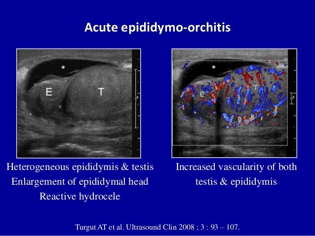 Doppler Ultrasound Of Acute Scrotum