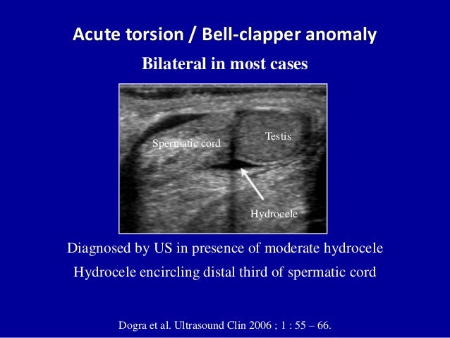 Doppler ultrasound of acute scrotum