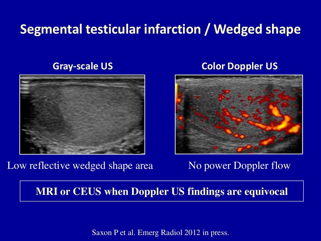 Doppler ultrasound of acute scrotum