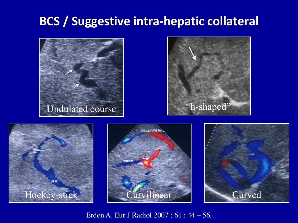 Doppler ultrasound of Budd Chiari syndrome & SOS