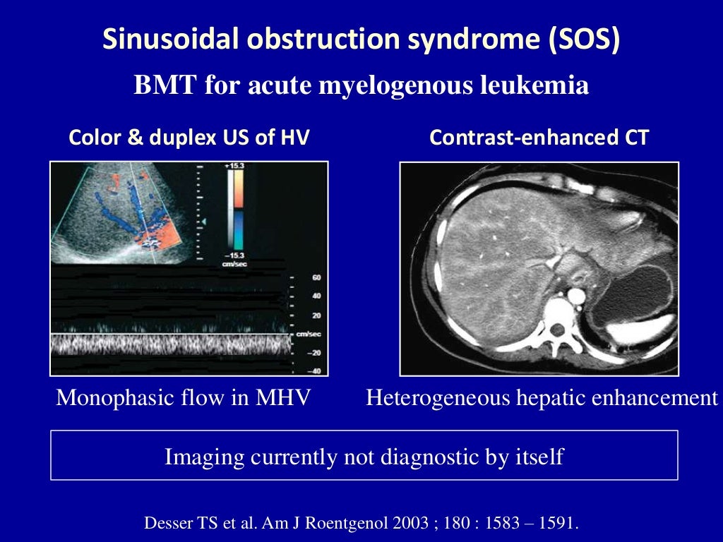 Doppler ultrasound of Budd Chiari syndrome & SOS