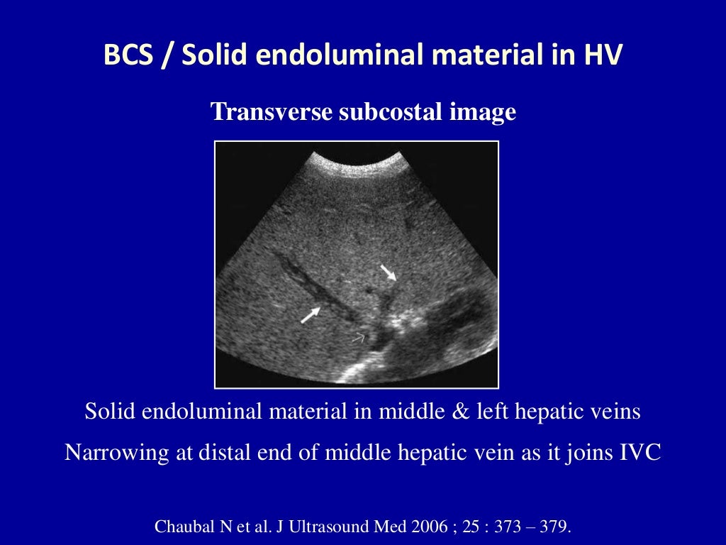Doppler ultrasound of Budd Chiari syndrome & SOS