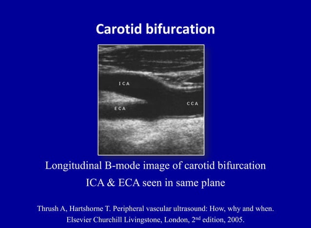 Doppler ultrasound of carotid arteries | PPTX