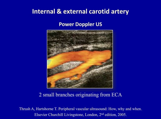 Doppler ultrasound of carotid arteries | PPTX