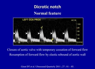 Doppler ultrasound of carotid arteries | PPTX