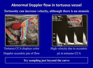 Doppler ultrasound of carotid arteries | PPTX