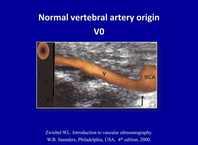 Doppler ultrasound of carotid arteries | PPTX