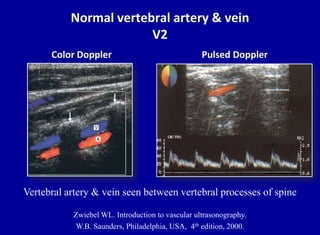 Doppler ultrasound of carotid arteries | PPTX