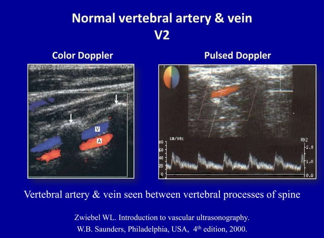 Doppler ultrasound of carotid arteries | PPTX