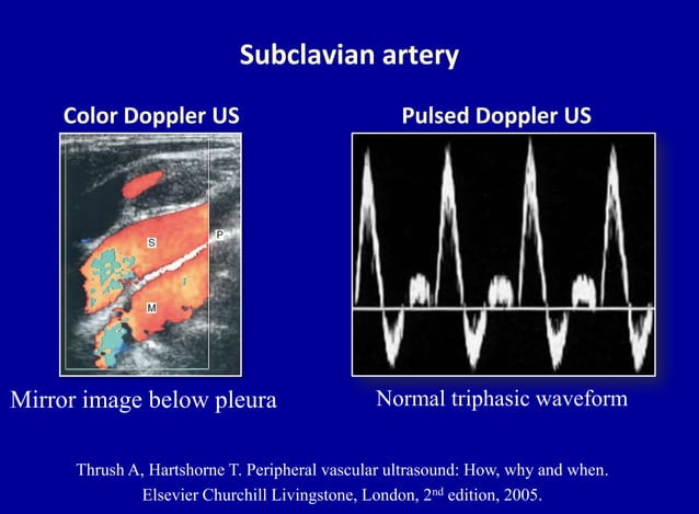 Doppler ultrasound of carotid arteries | PPTX