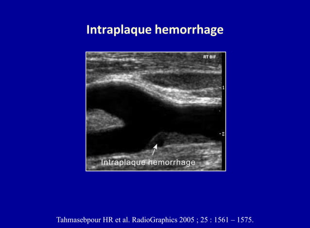 Doppler ultrasound of carotid arteries | PPTX