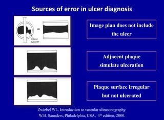 Doppler ultrasound of carotid arteries | PPTX