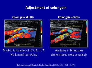 Doppler ultrasound of carotid arteries | PPTX