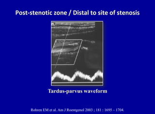 Doppler ultrasound of carotid arteries | PPTX