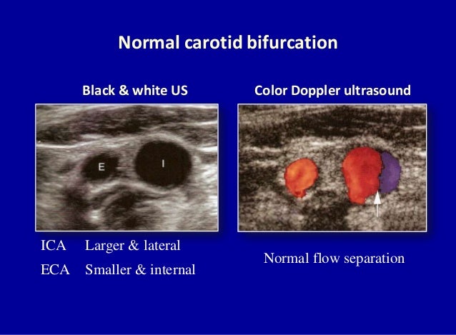 Doppler ultrasound of carotid arteries