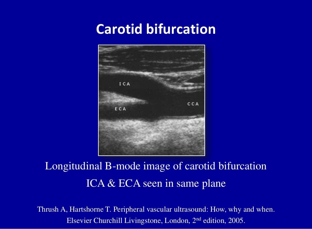 Doppler ultrasound of carotid arteries