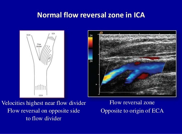 Doppler ultrasound of carotid arteries
