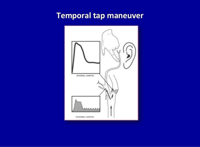 Doppler ultrasound of carotid arteries