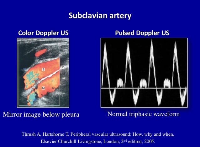 Doppler ultrasound of carotid arteries