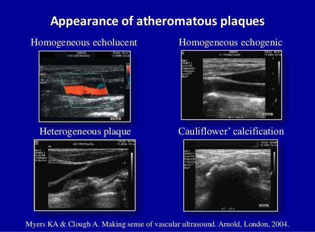Doppler ultrasound of carotid arteries