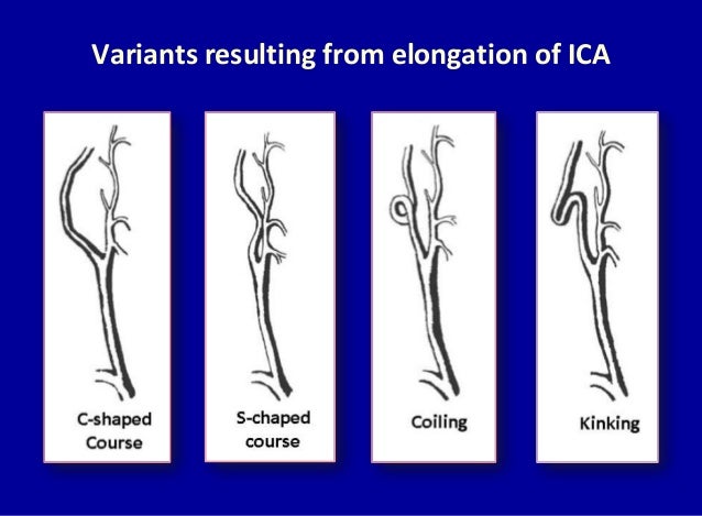 Doppler ultrasound of carotid arteries