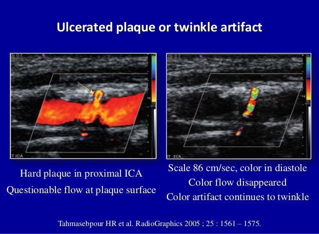 Doppler ultrasound of carotid arteries
