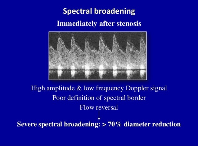 Doppler ultrasound of carotid arteries