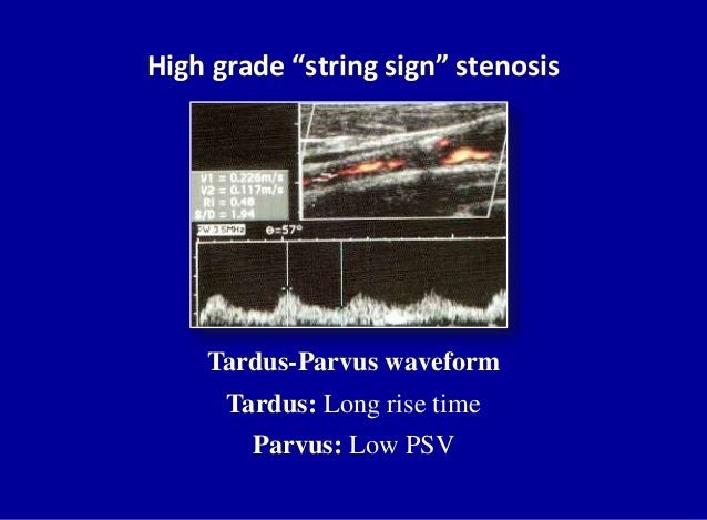 Doppler ultrasound of carotid arteries