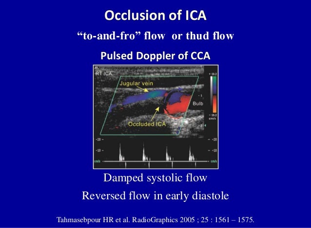 Doppler ultrasound of carotid arteries