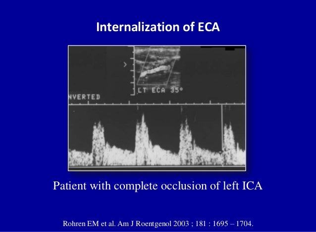 Doppler ultrasound of carotid arteries