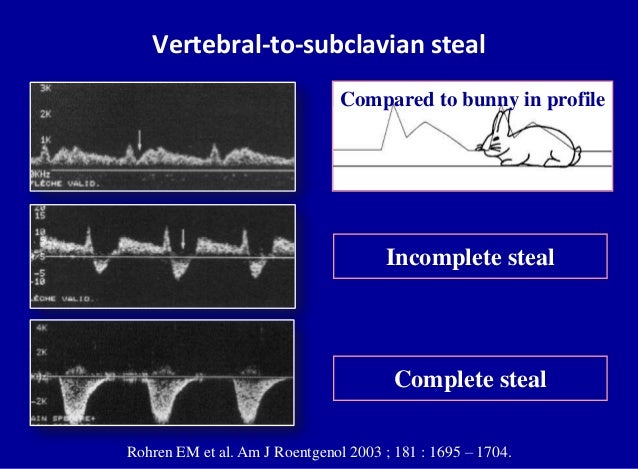 Doppler ultrasound of carotid arteries