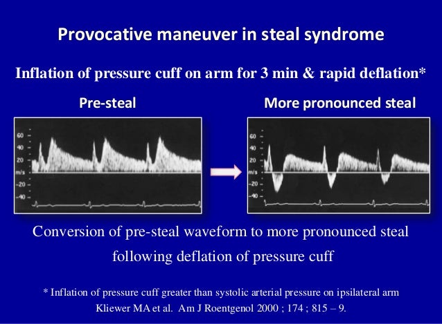 Doppler ultrasound of carotid arteries