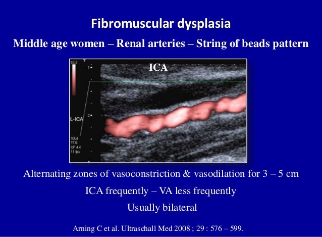 Doppler ultrasound of carotid arteries