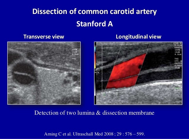 Doppler ultrasound of carotid arteries