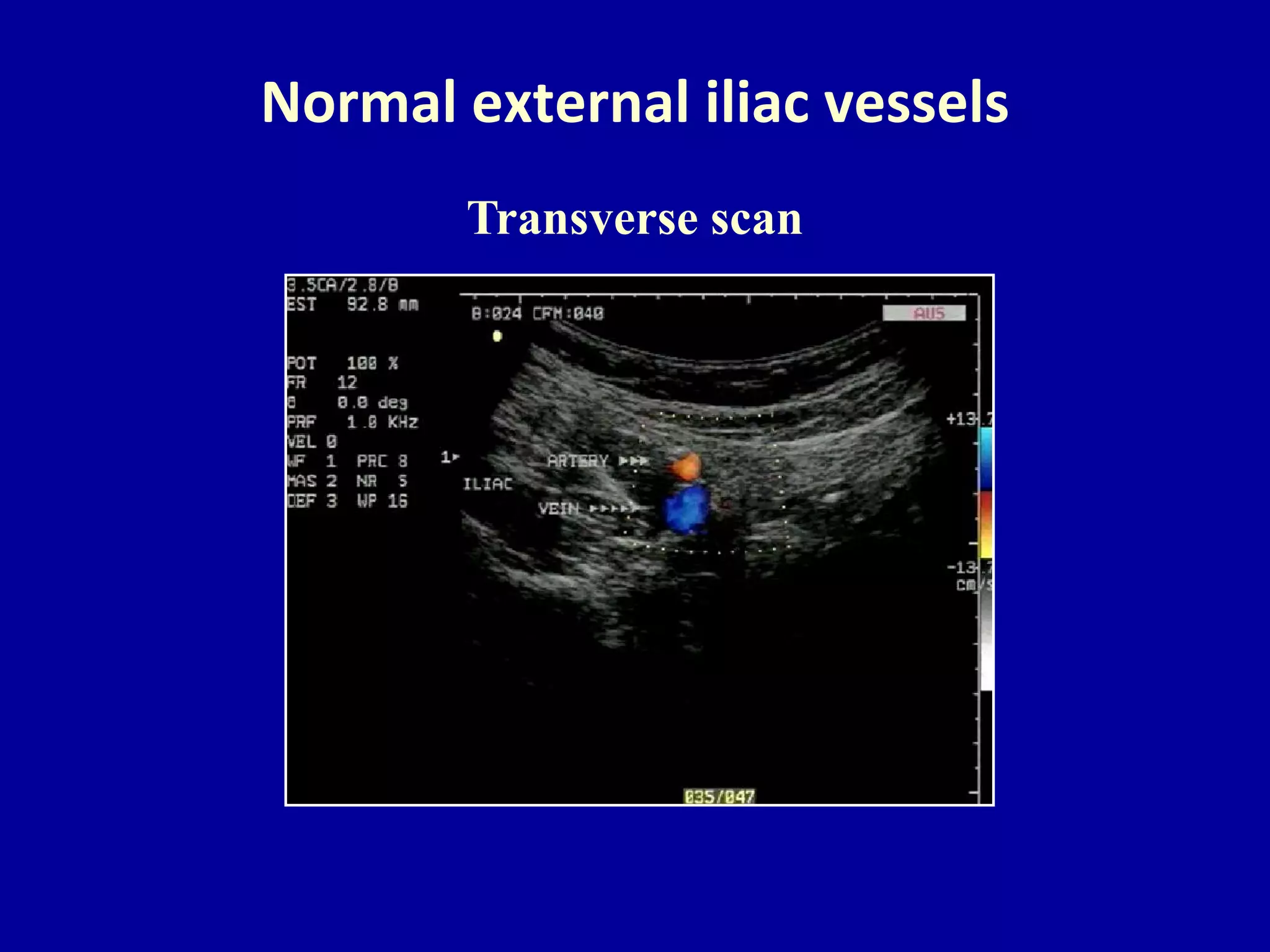 Doppler ultrasound of lower limb arteries | PPTX