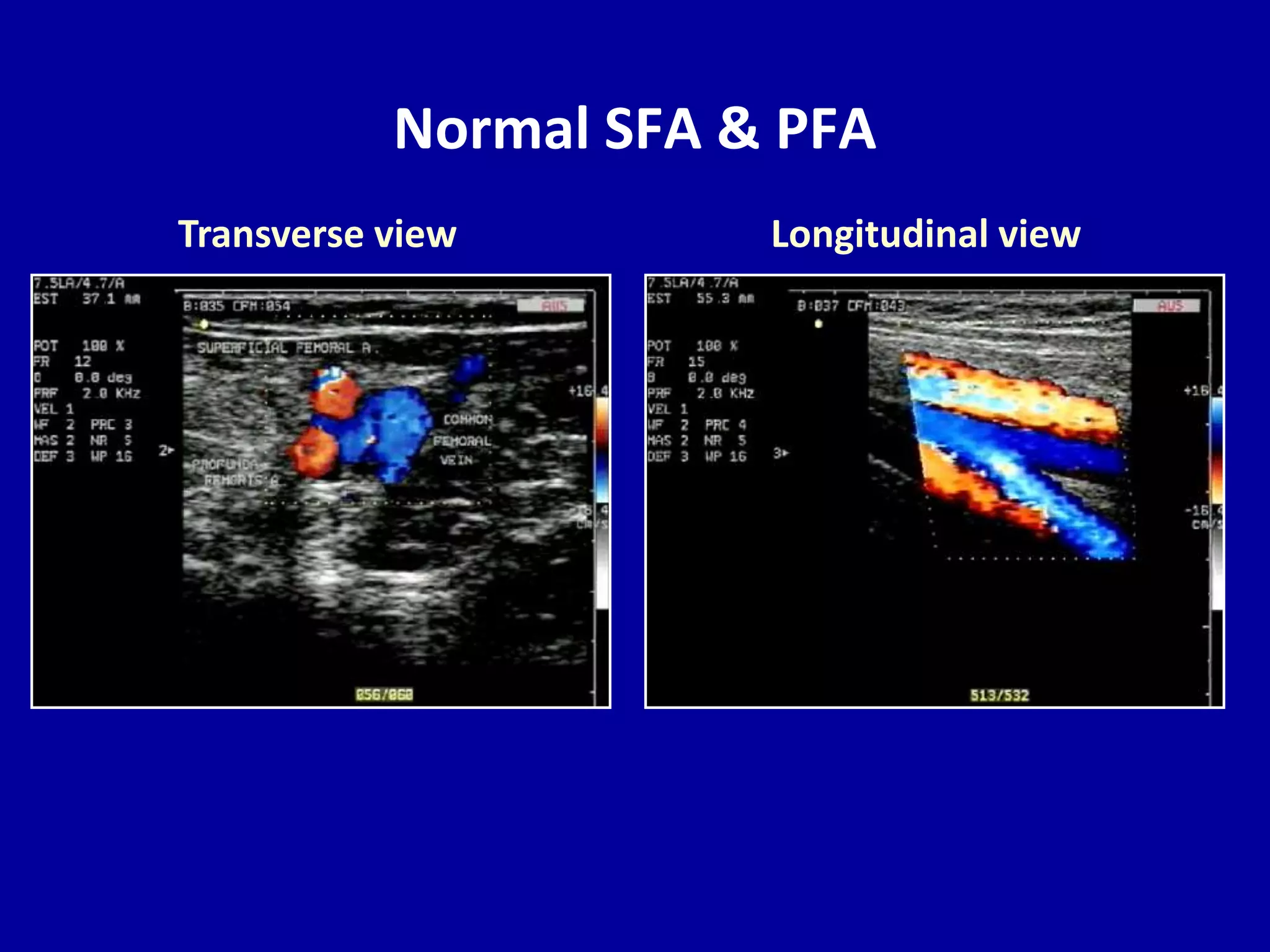 Doppler ultrasound of lower limb arteries | PPTX