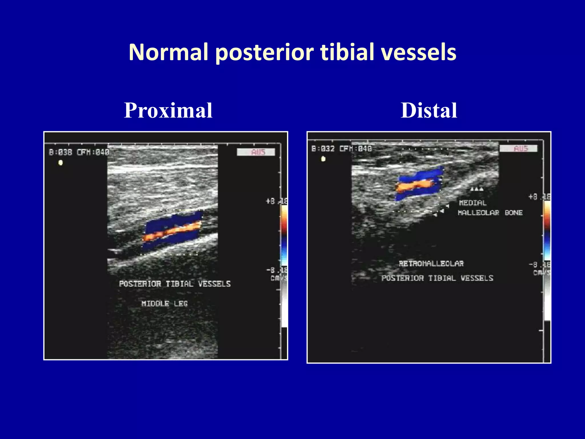 Doppler ultrasound of lower limb arteries | PPTX
