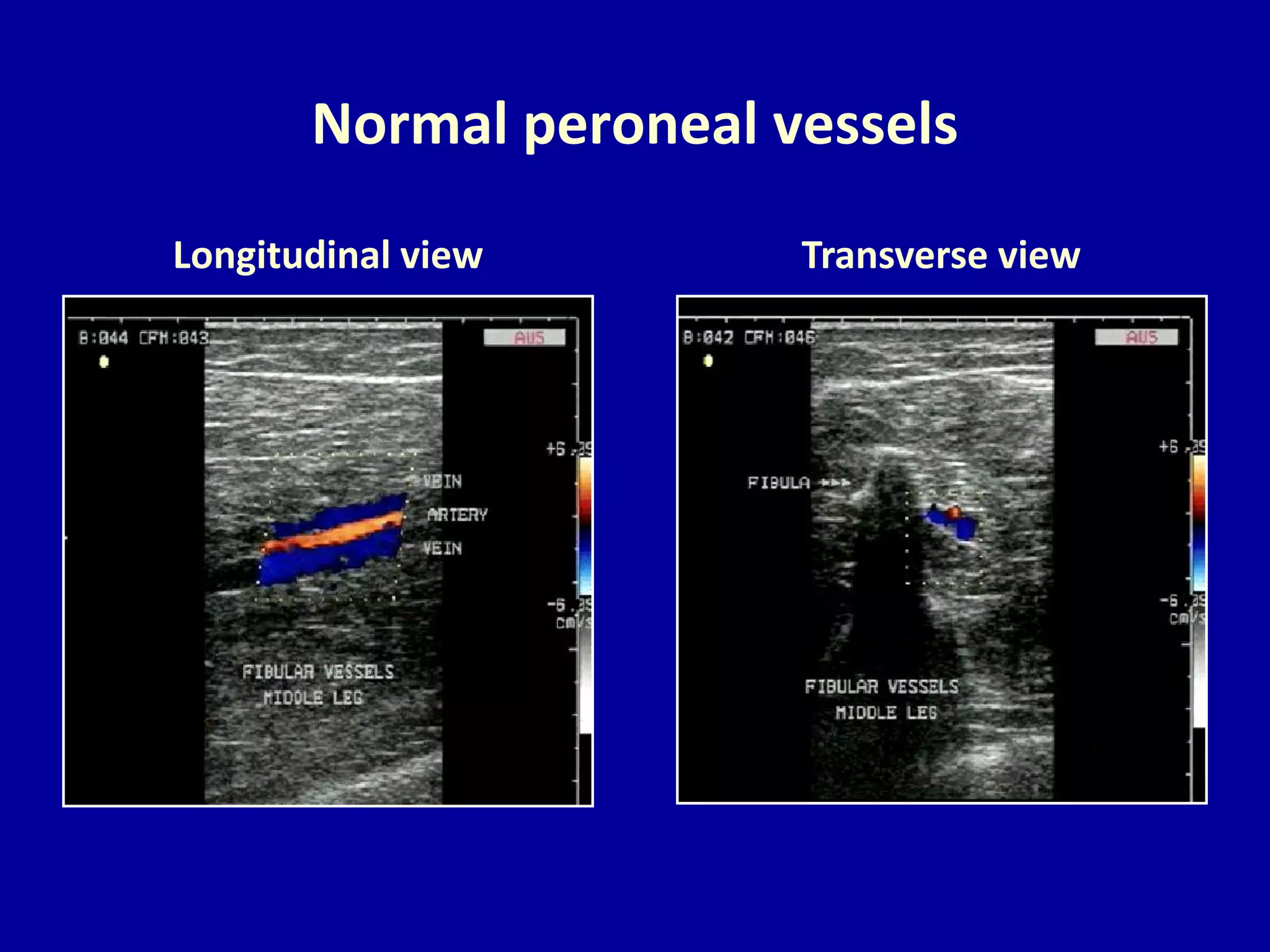 Doppler ultrasound of lower limb arteries | PPTX