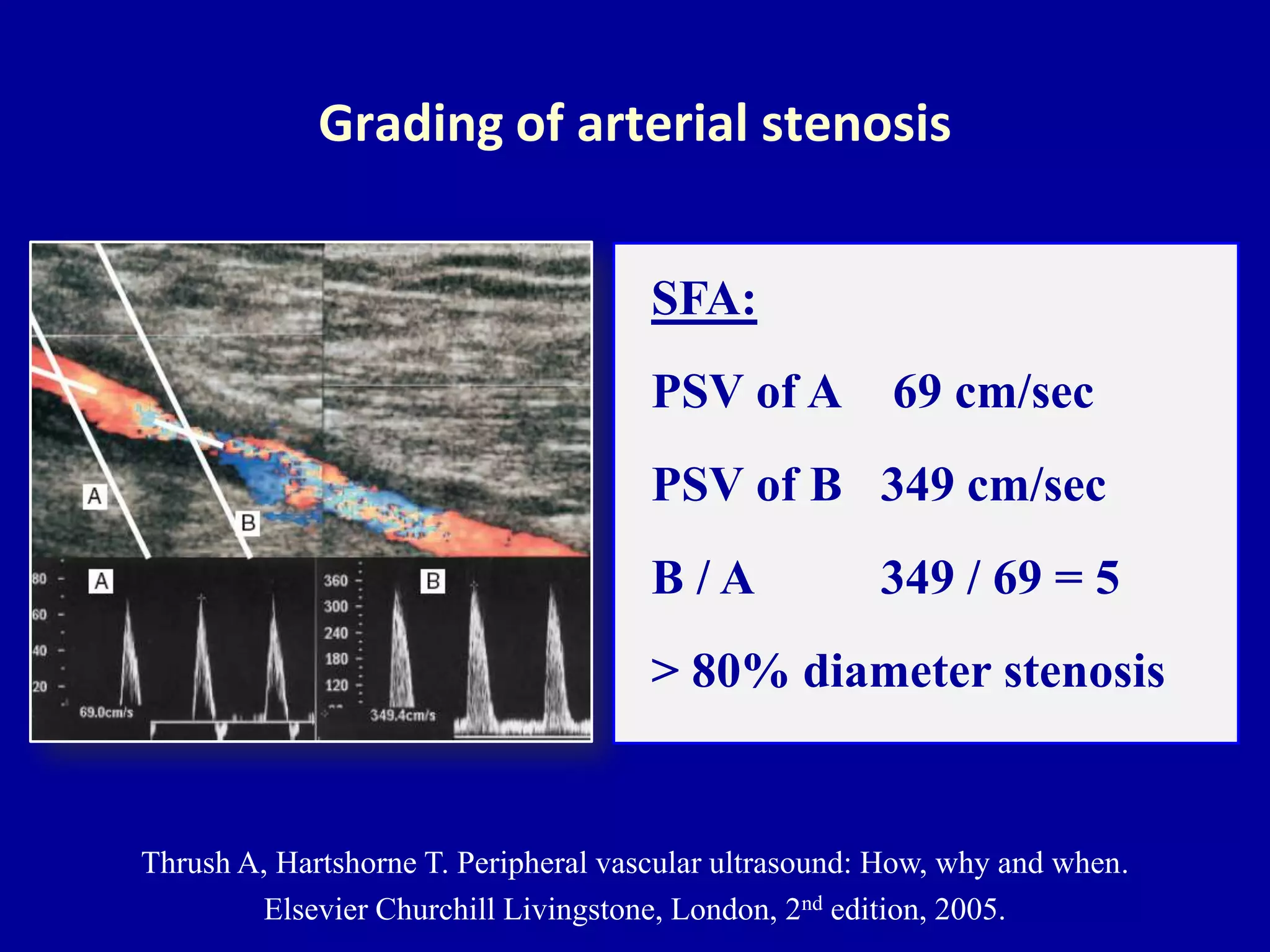 Doppler ultrasound of lower limb arteries | PPTX