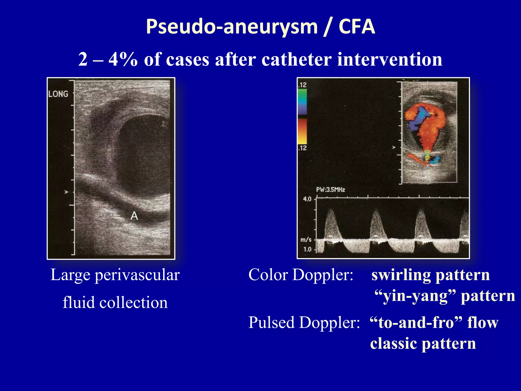 Doppler ultrasound of lower limb arteries | PPTX