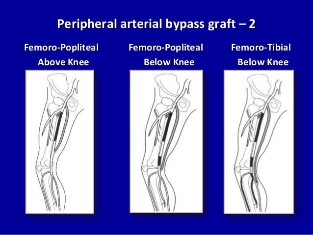 Doppler ultrasound of lower limb arteries